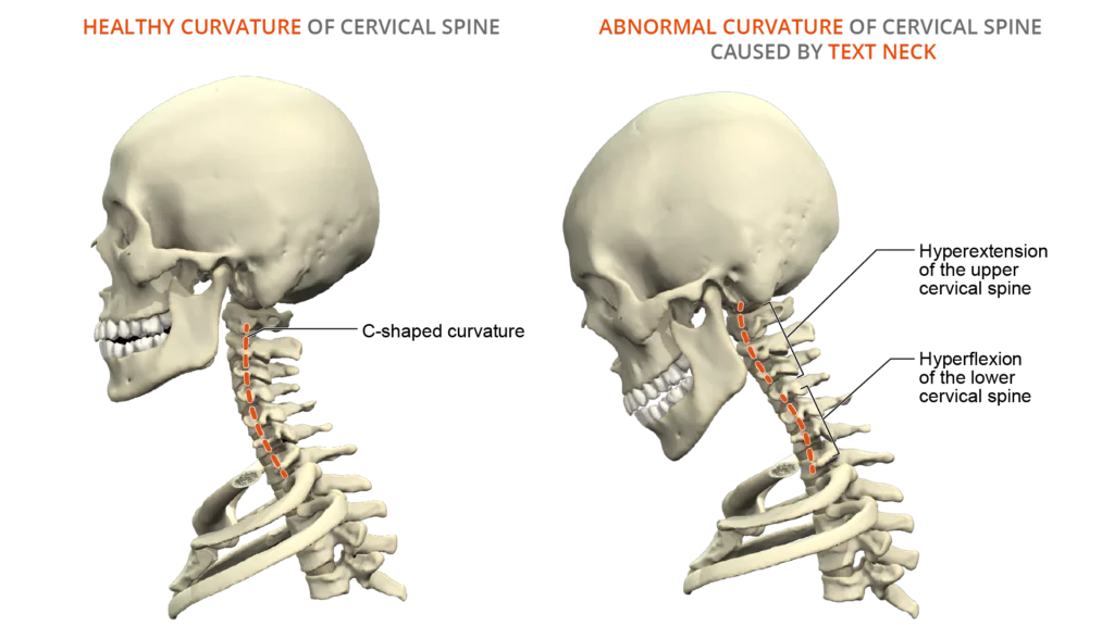 Text Neck: Anatomy of a Modern Spine Condition